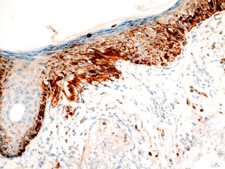 HMB-45 – Antibody Lexicon