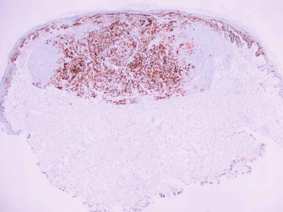 HMB-45 – Antibody Lexicon