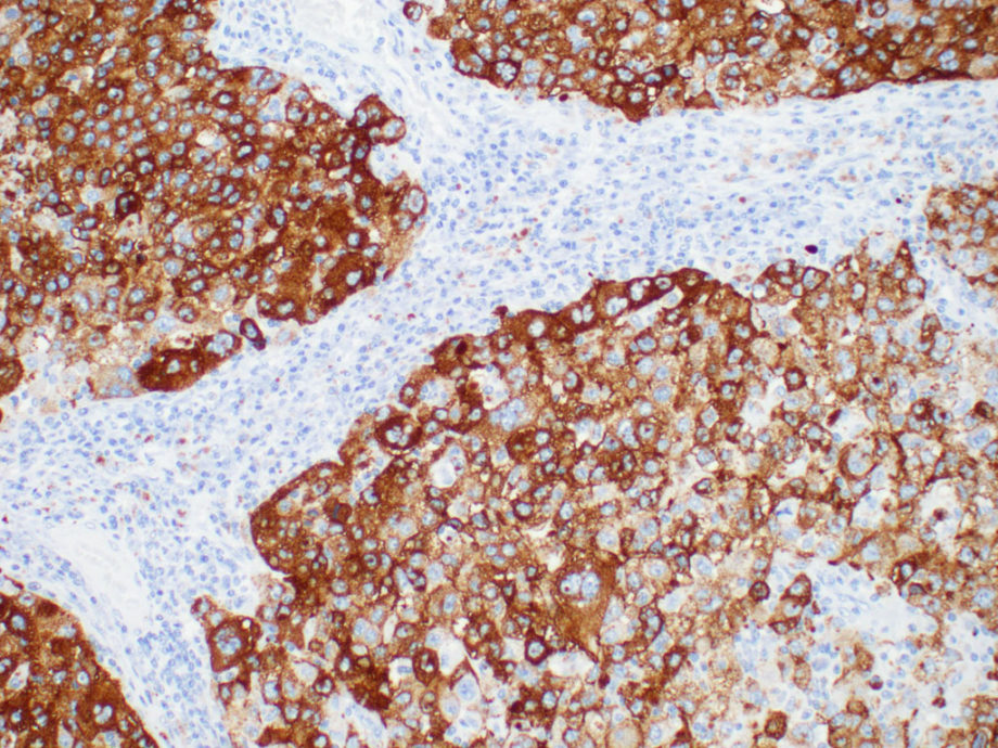 HMB-45 – Antibody Lexicon